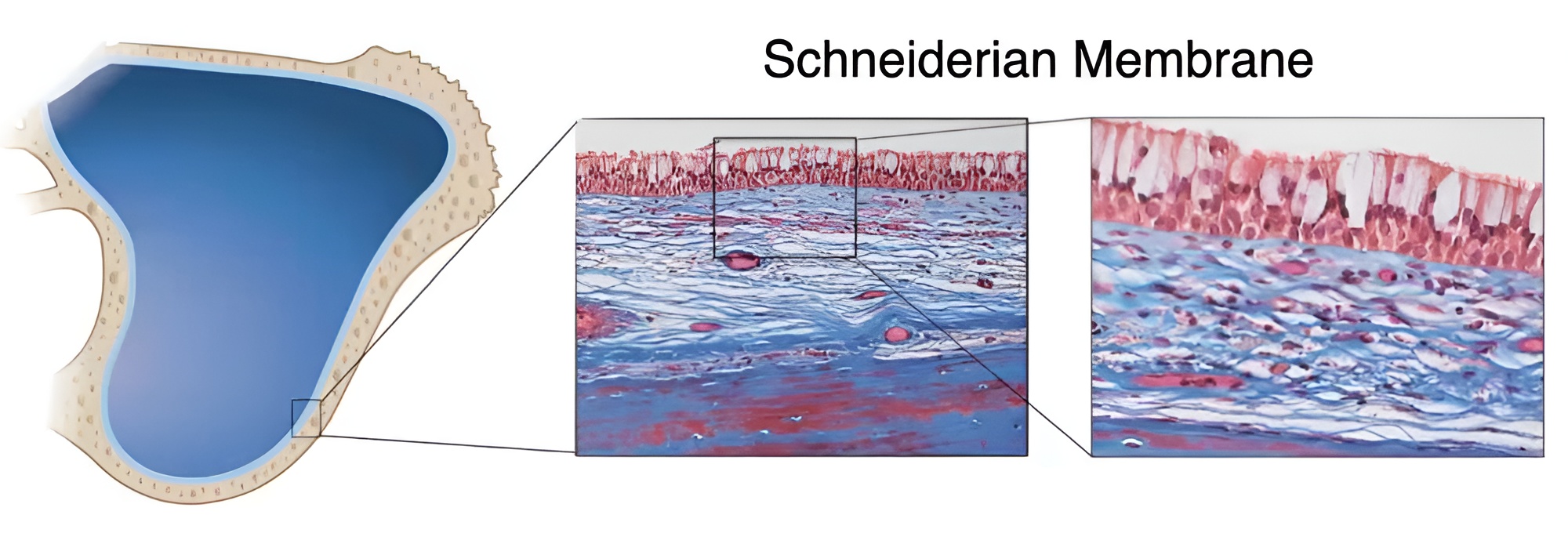 Sinus Lifting: Direct vs. Indirect Approach - 3Sixty