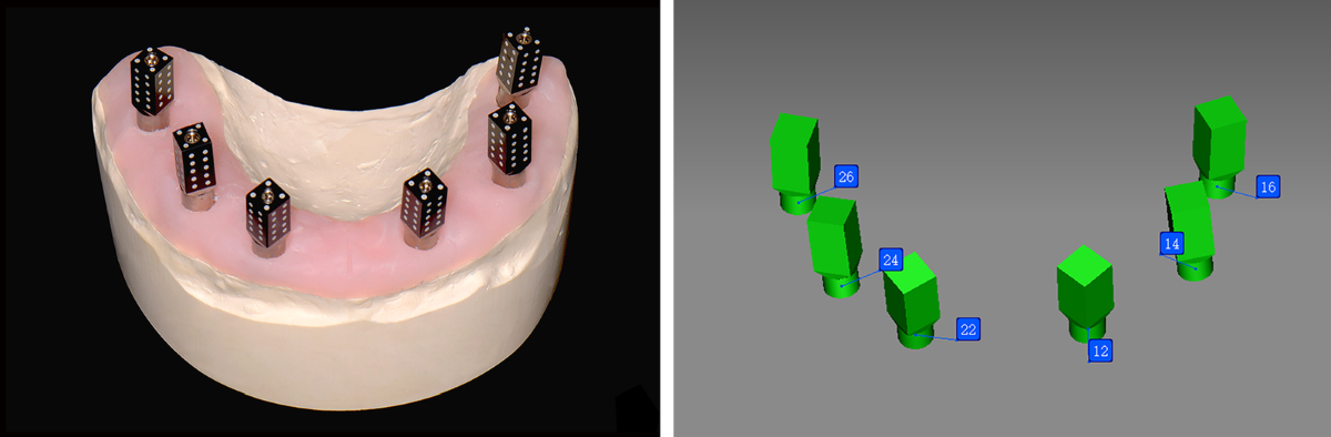 How to Integrate Photogrammetry in Digital Workflows for Guided Full-Arch Rehabilitation - 3Sixty